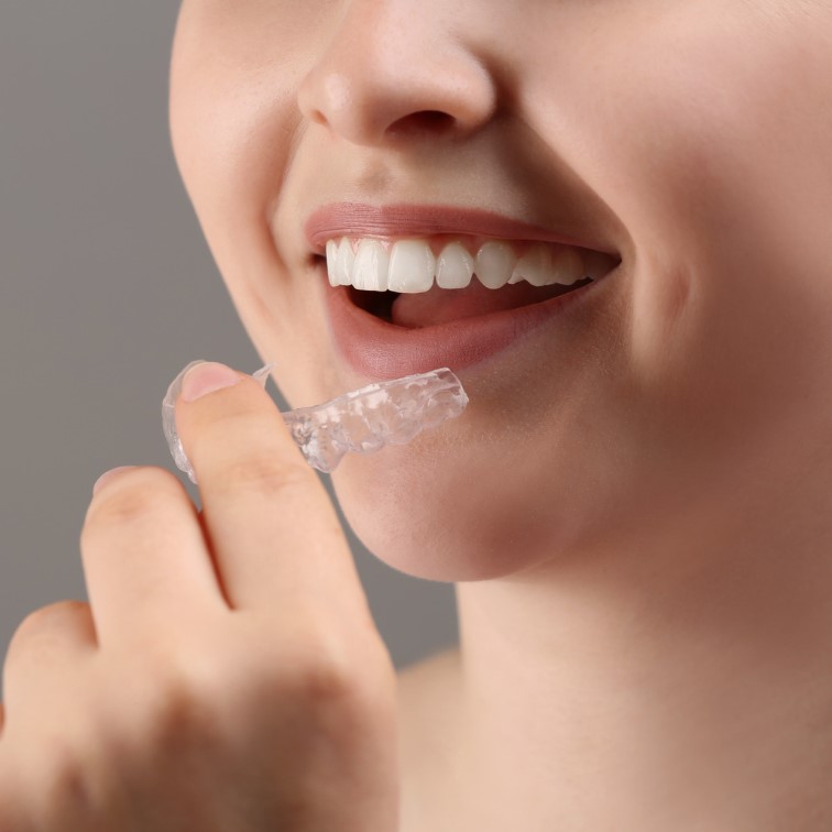 Férula de descarga para el bruxismo | Dr. Mazarro